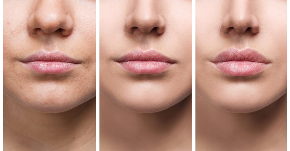 Dermal Fillers – Semona Michelle